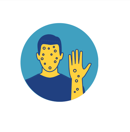 Mpox (aka monkeypox): What to Know | City of Alexandria, VA